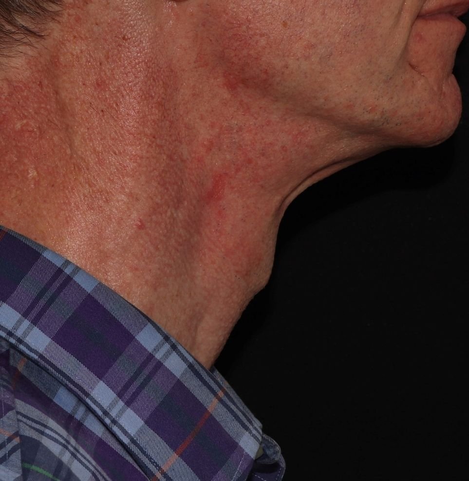 V Beam | Pulsed Dye Laser | Redness Treatment | PHI Clinic