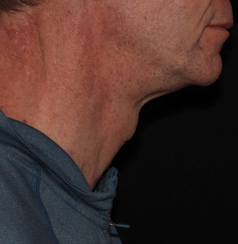 V Beam | Pulsed Dye Laser | Redness Treatment | PHI Clinic