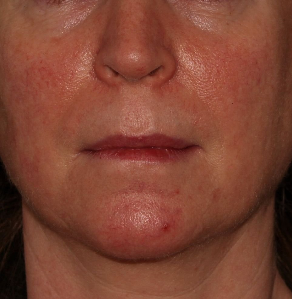 V Beam | Pulsed Dye Laser | Redness Treatment | PHI Clinic