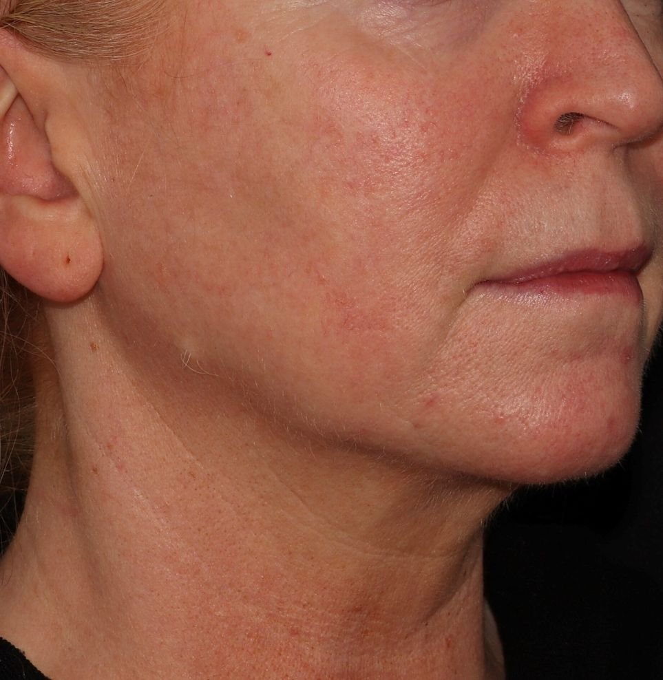 V Beam | Pulsed Dye Laser | Redness Treatment | PHI Clinic