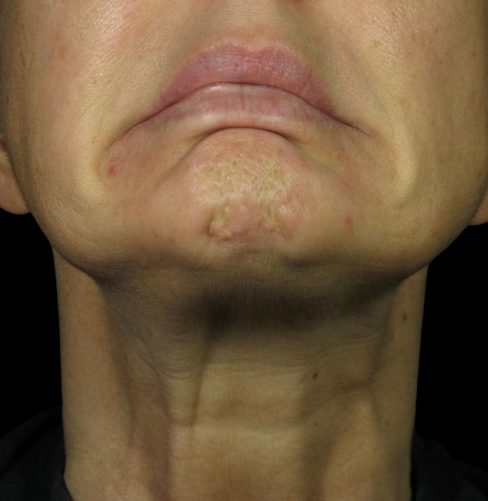 Botox Before & After | PHI Clinic London