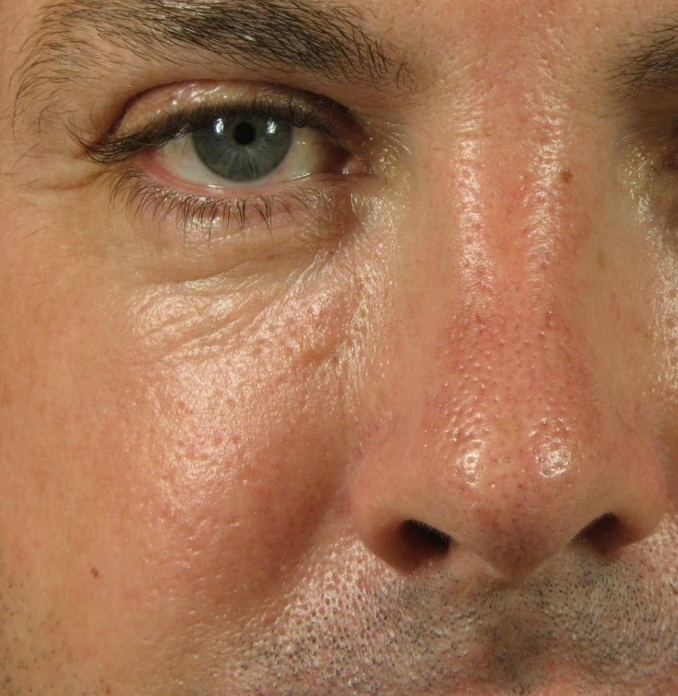 Tear Trough | Tear Trough Filler | PHI Clinic London