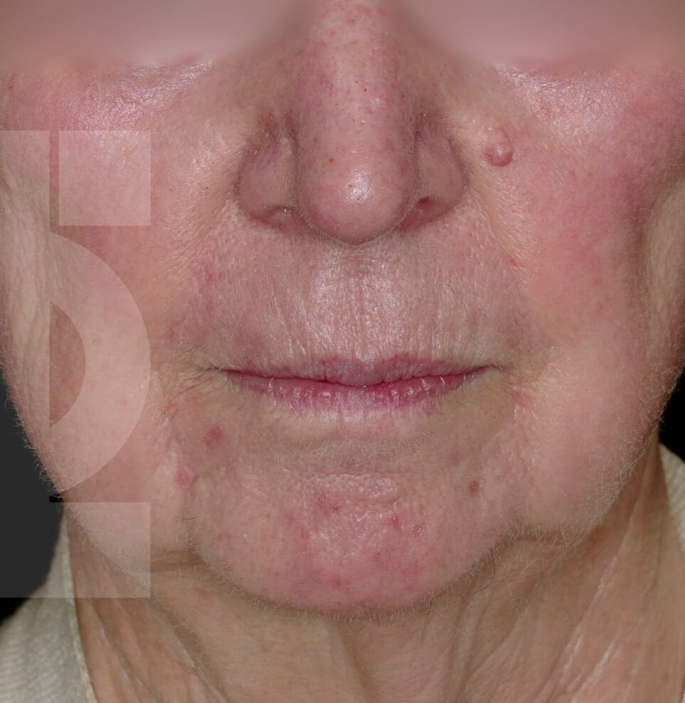 Laser Resurfacing Before and After - PHI Clinic London