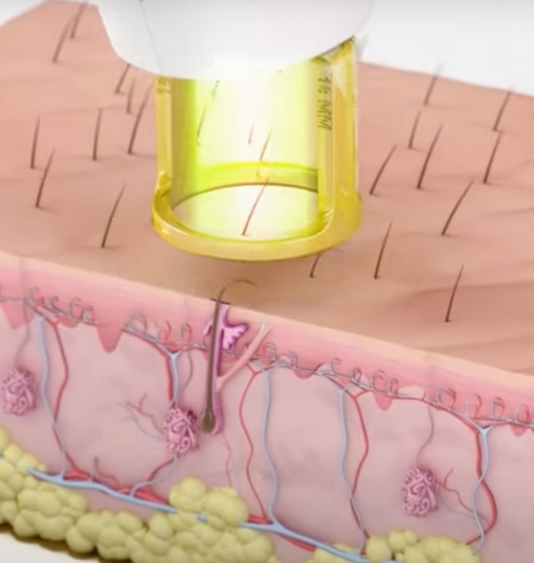 Gentlemax Pro Treatment | PHI Clinic | London